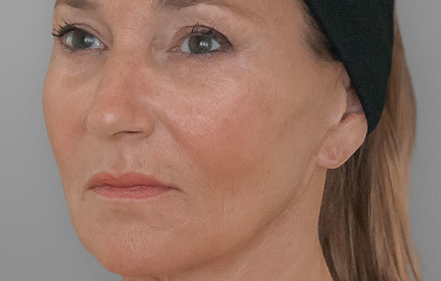 Dermal Filler For Facial Collagen Stimulation | ELLANSÉ - Ellansé