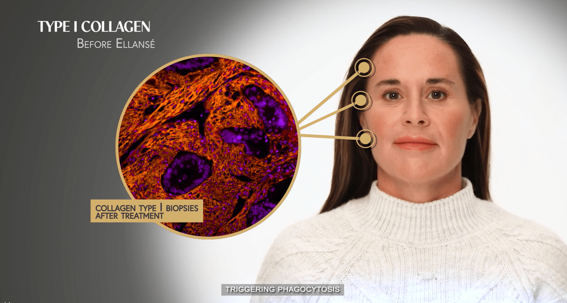 ELLANSÉ | Dermal Fillers for Natural Collagen Stimulation - Ellansé