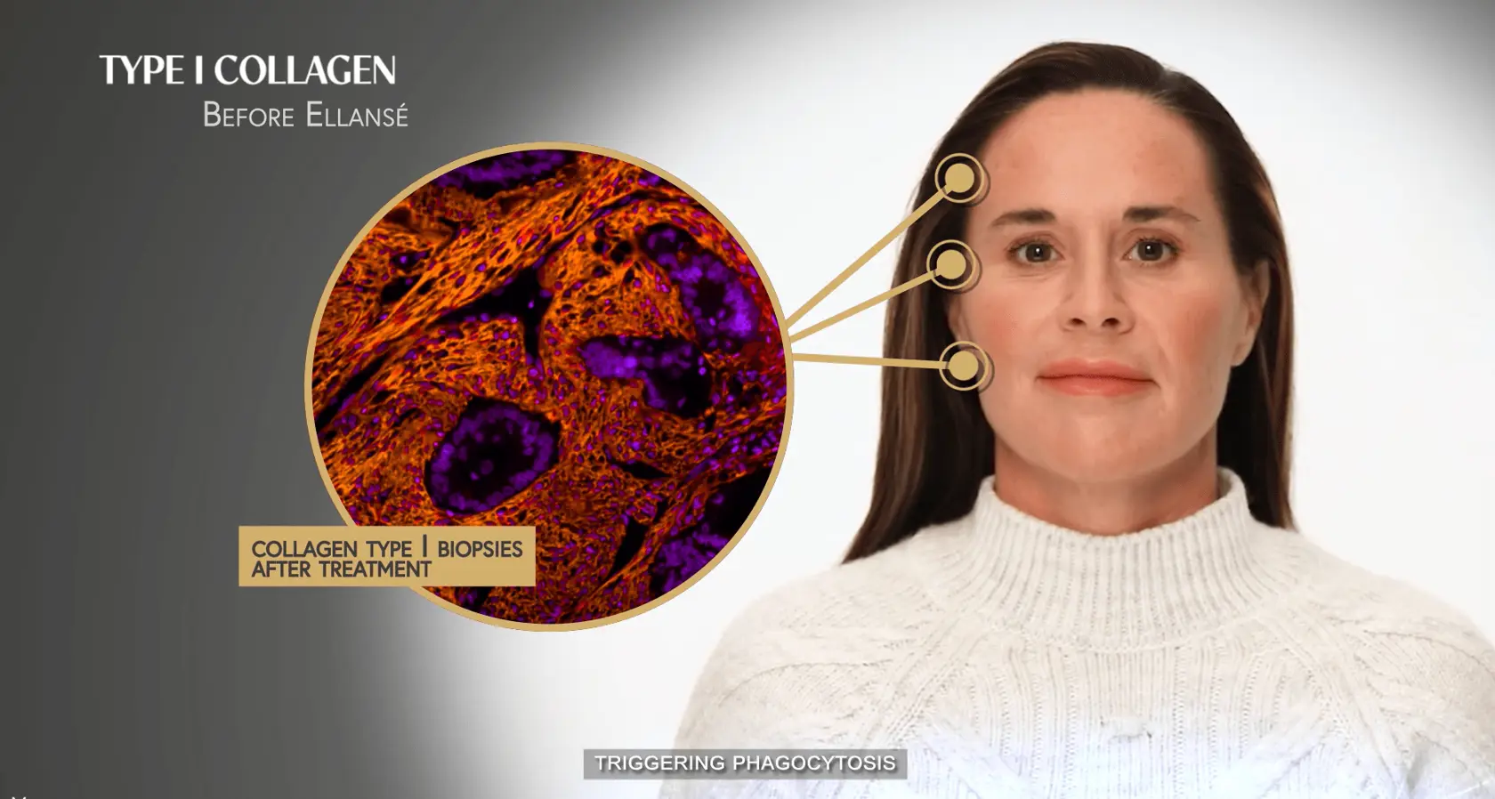 ELLANSÉ | Dermal Fillers for Natural Collagen Stimulation - Ellansé